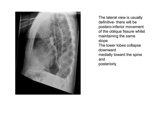 Collapse and consolidation Lung Radiology | PPT