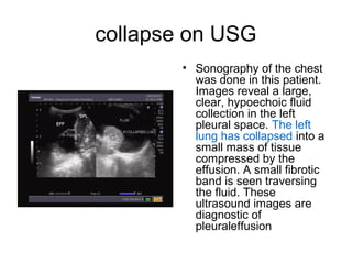 Collapse and consolidation Lung Radiology | PPT