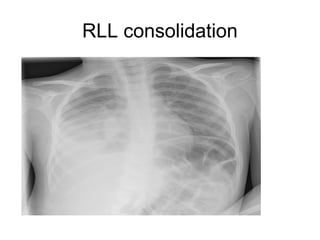 Collapse and consolidation Lung Radiology | PPT