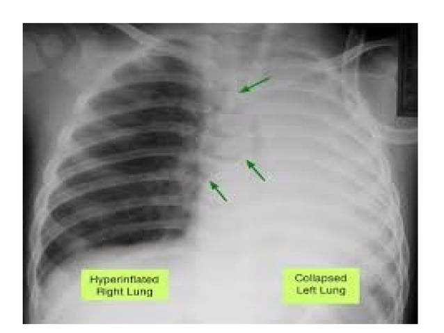 Collapse and consolidation Lung Radiology | PPT