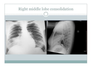 Chest X Ray Consolidation