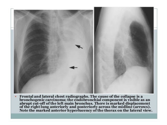 Collapse and consolidation Lung Radiology