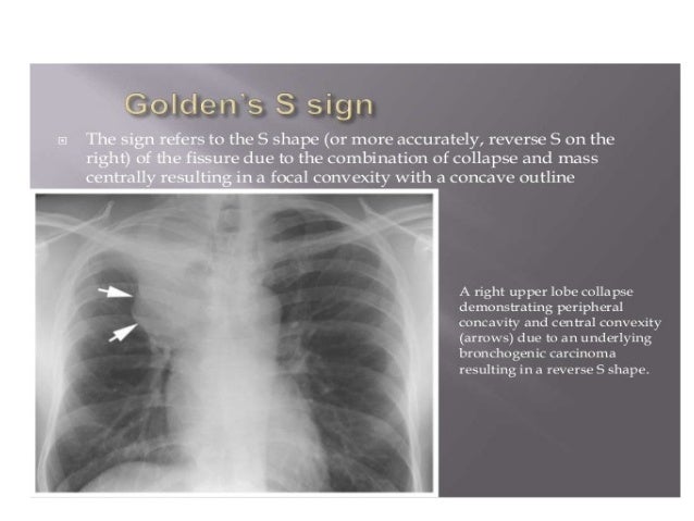 Collapse and consolidation Lung Radiology