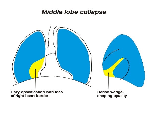 Collapse and consolidation Lung Radiology