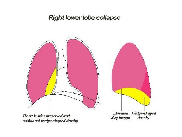 Collapse and consolidation Lung Radiology
