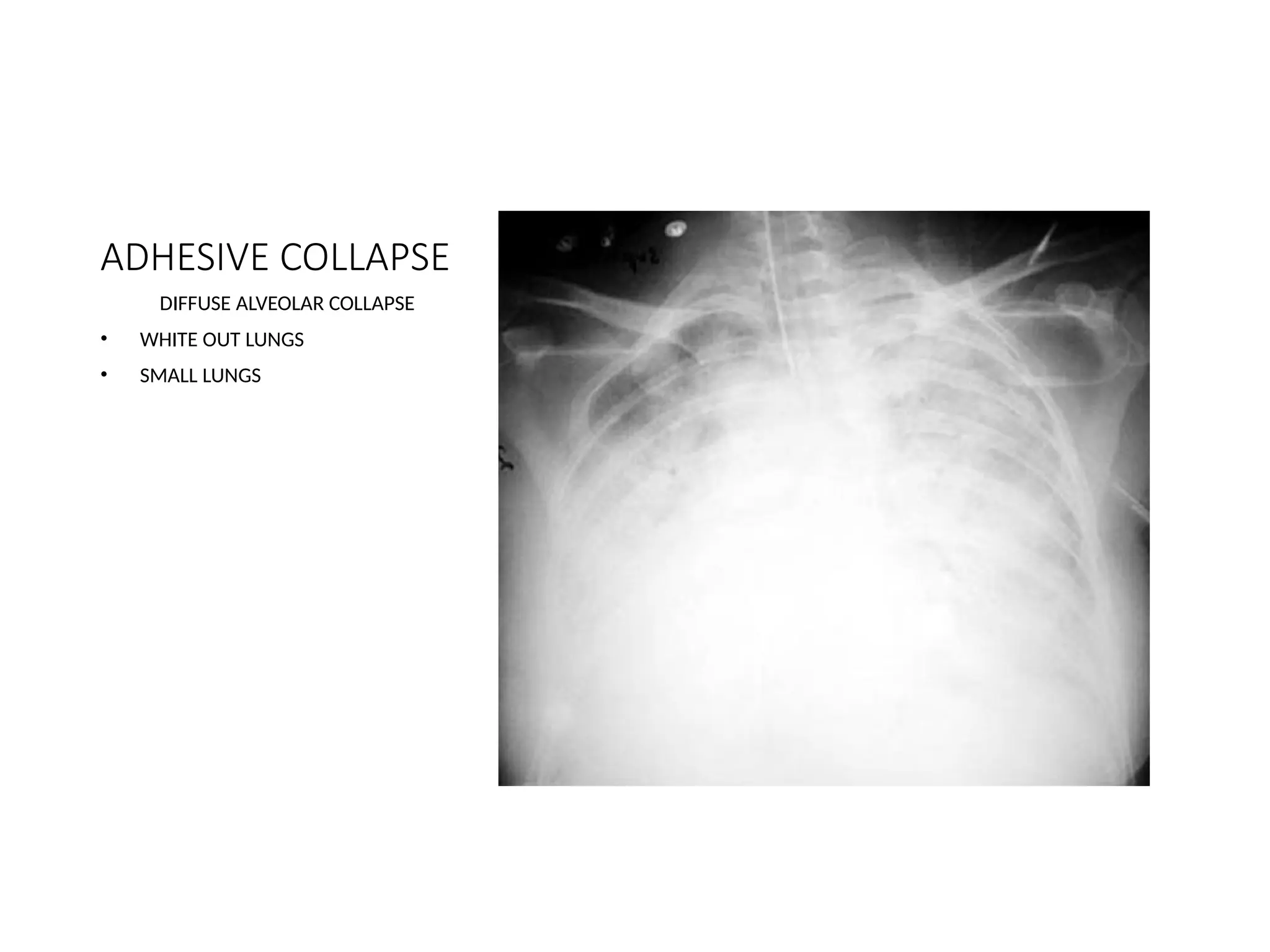 Collapse and Consolidation Pathology and radiology | PPTX