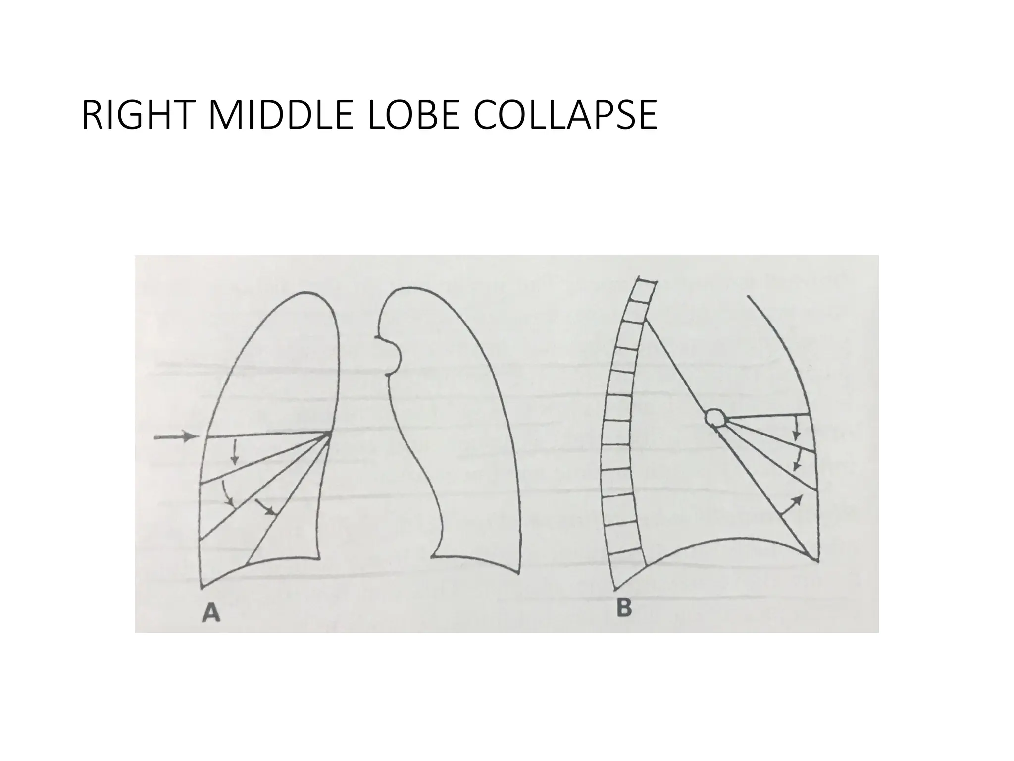 Collapse and Consolidation Pathology and radiology | PPTX
