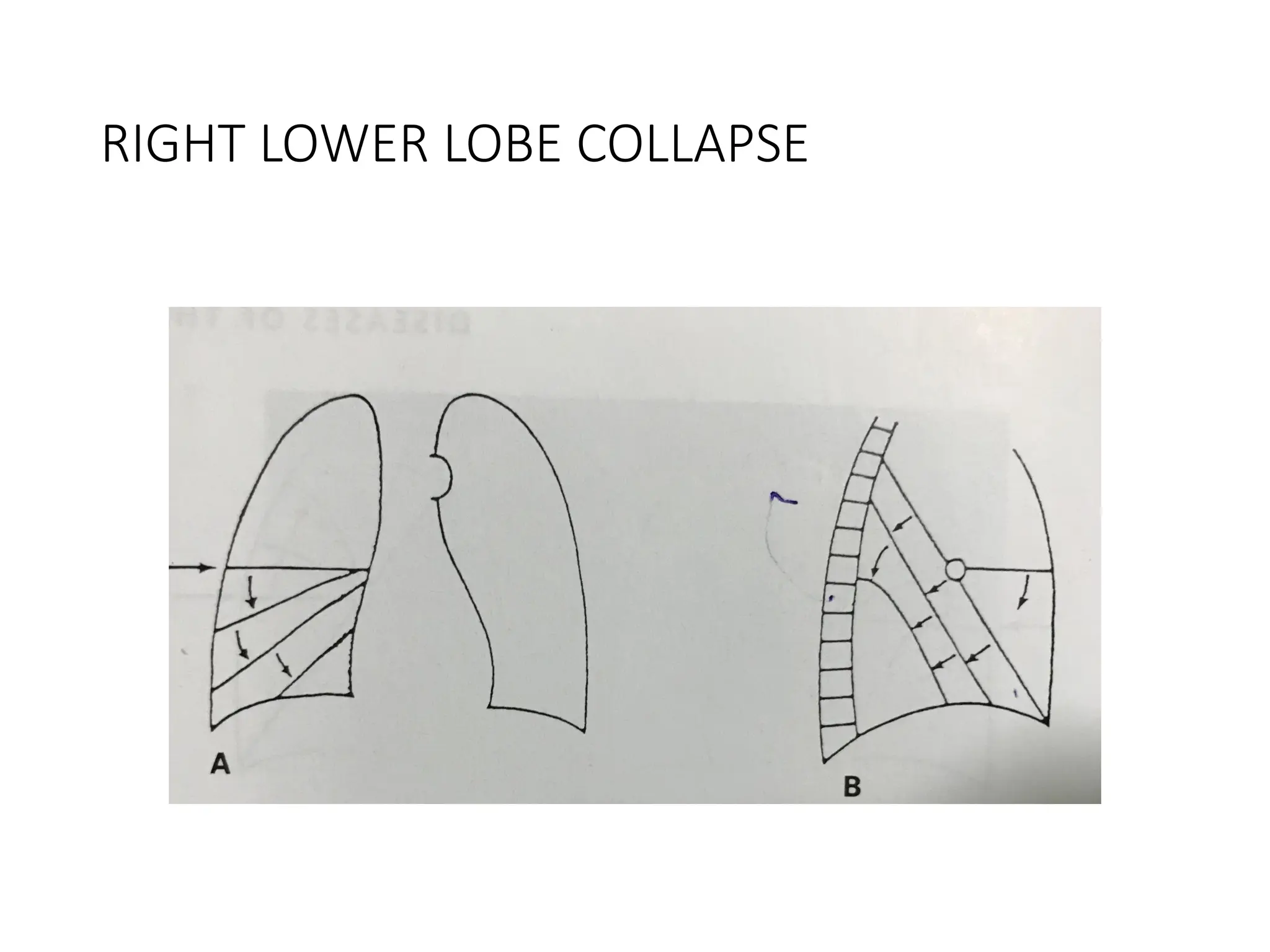 Collapse and Consolidation Pathology and radiology | PPTX