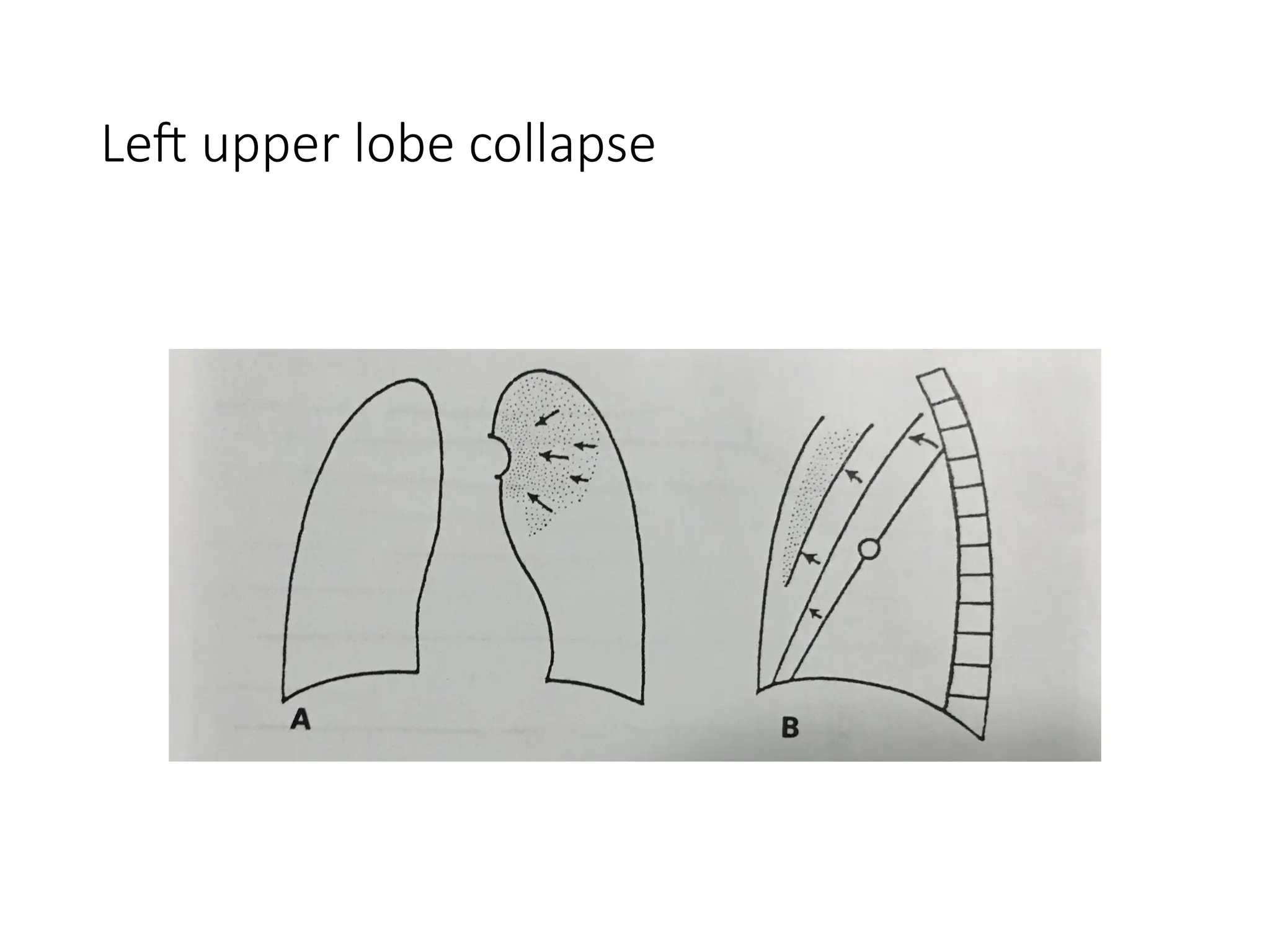 Collapse and Consolidation Pathology and radiology | PPTX