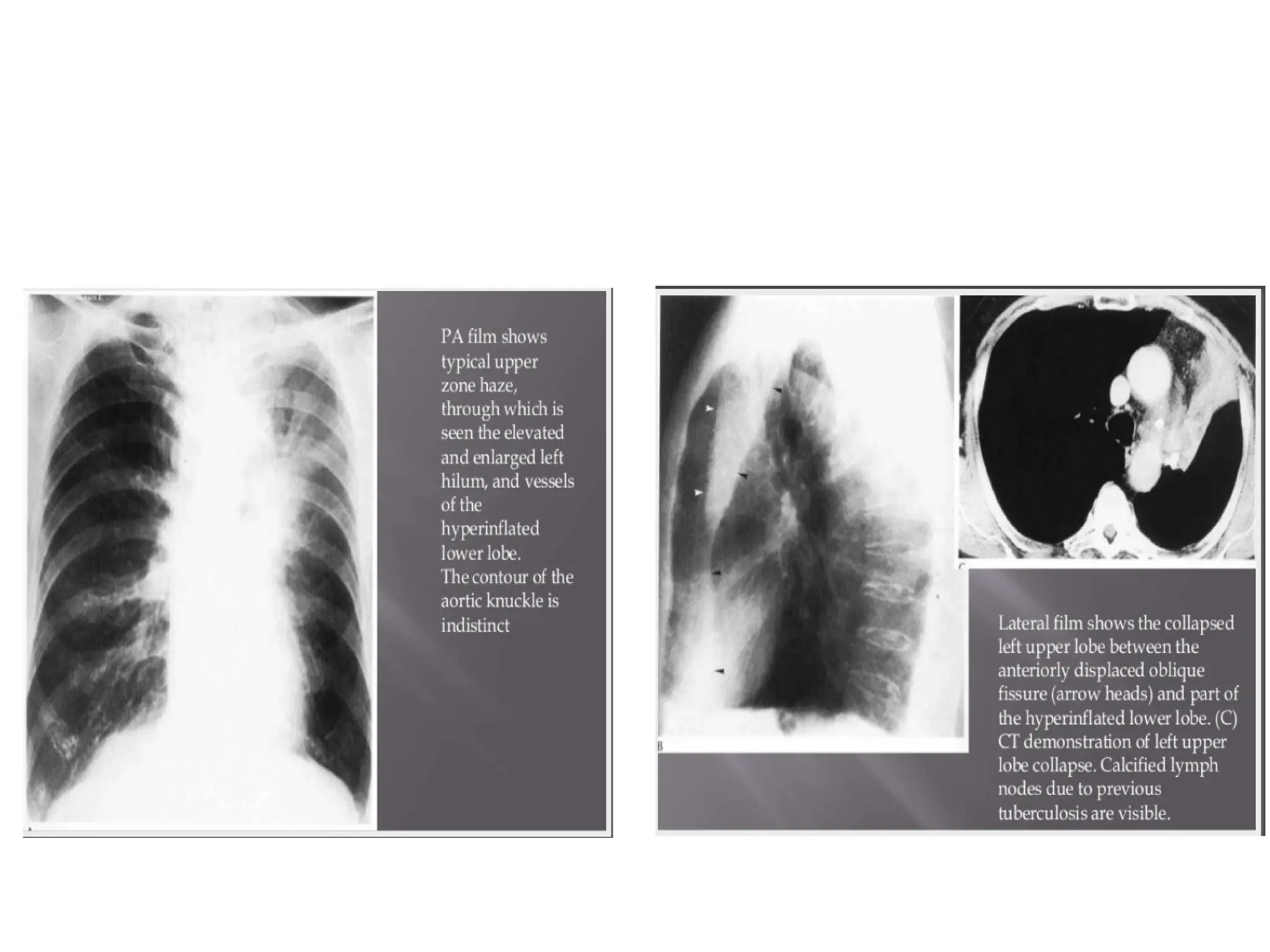 Collapse and Consolidation Pathology and radiology | PPTX