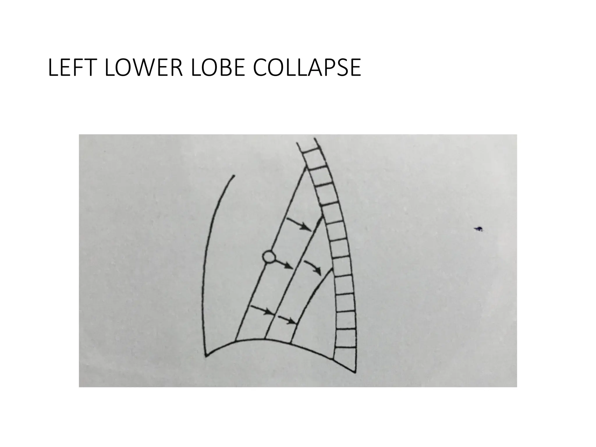 Collapse and Consolidation Pathology and radiology | PPTX