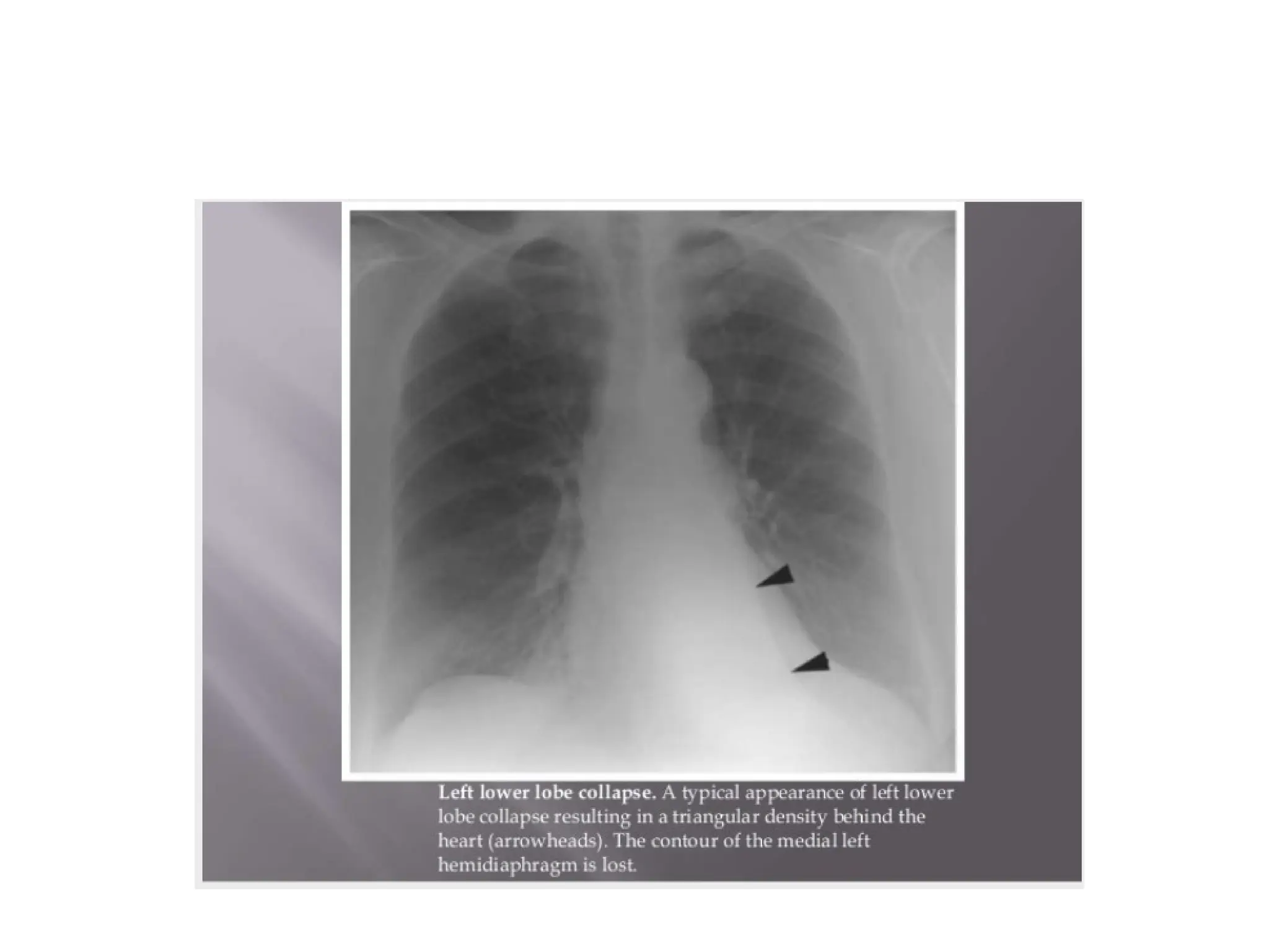 Collapse and Consolidation Pathology and radiology | PPTX