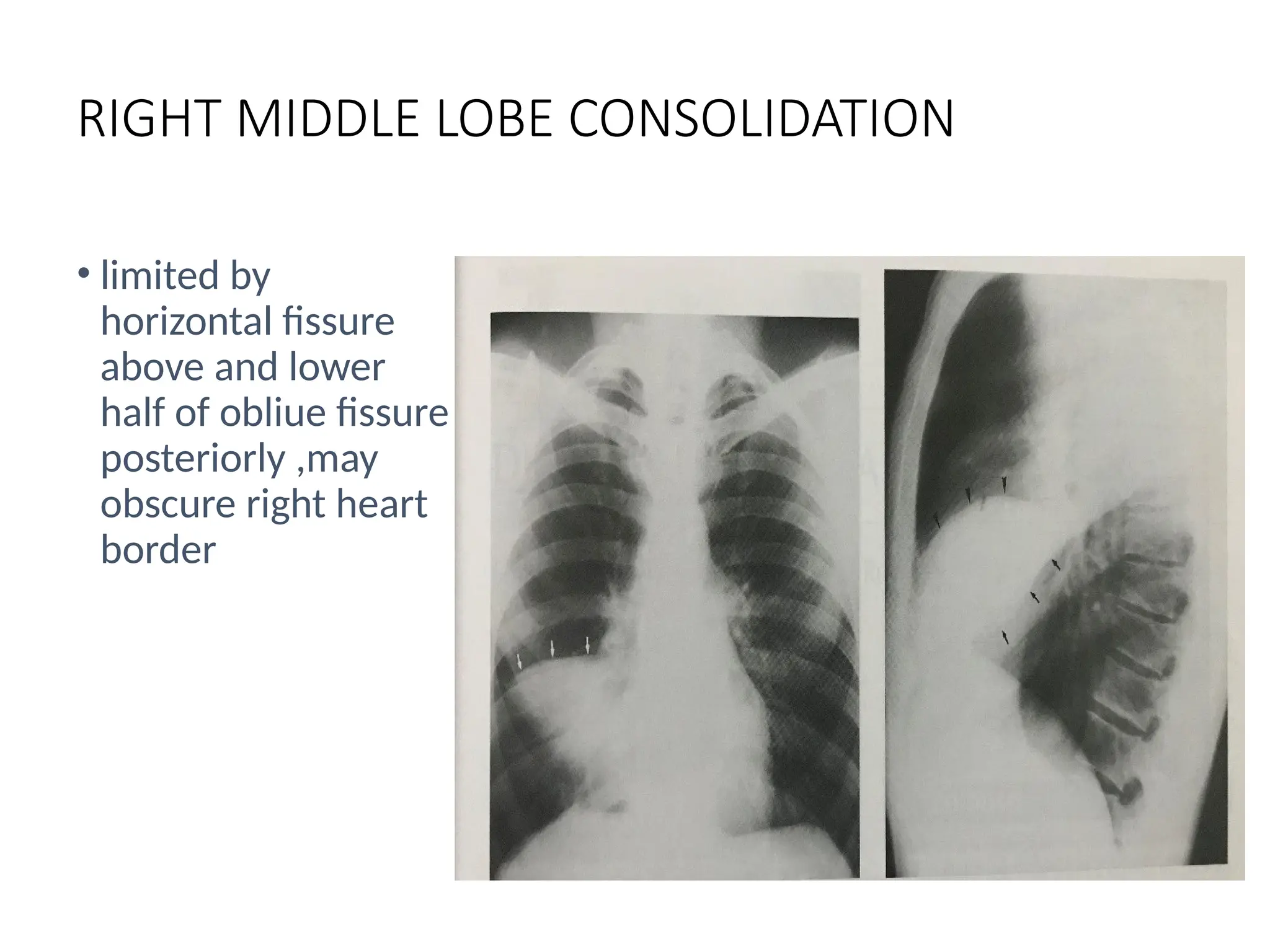 Collapse and Consolidation Pathology and radiology | PPTX