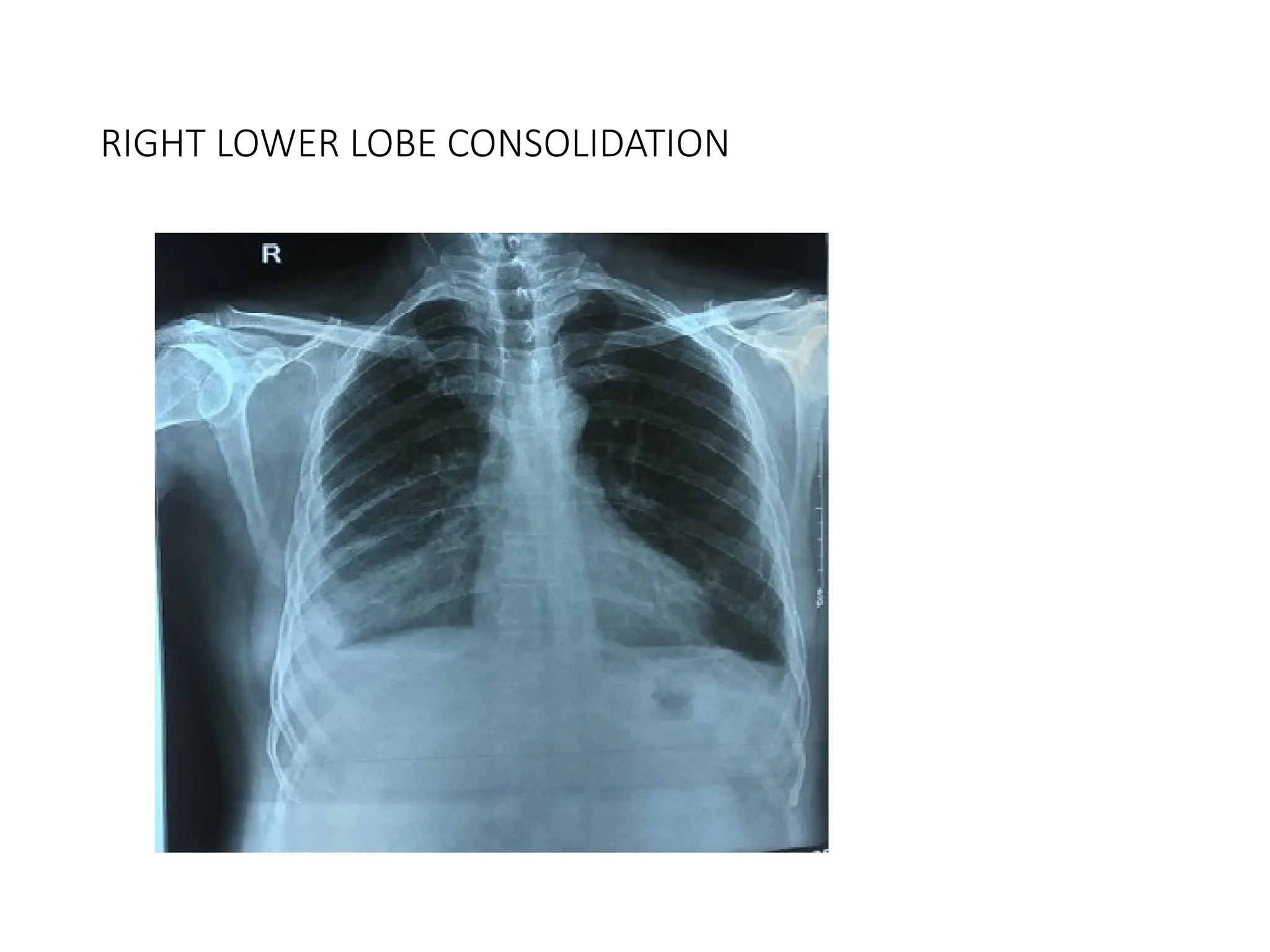Collapse and Consolidation Pathology and radiology | PPTX