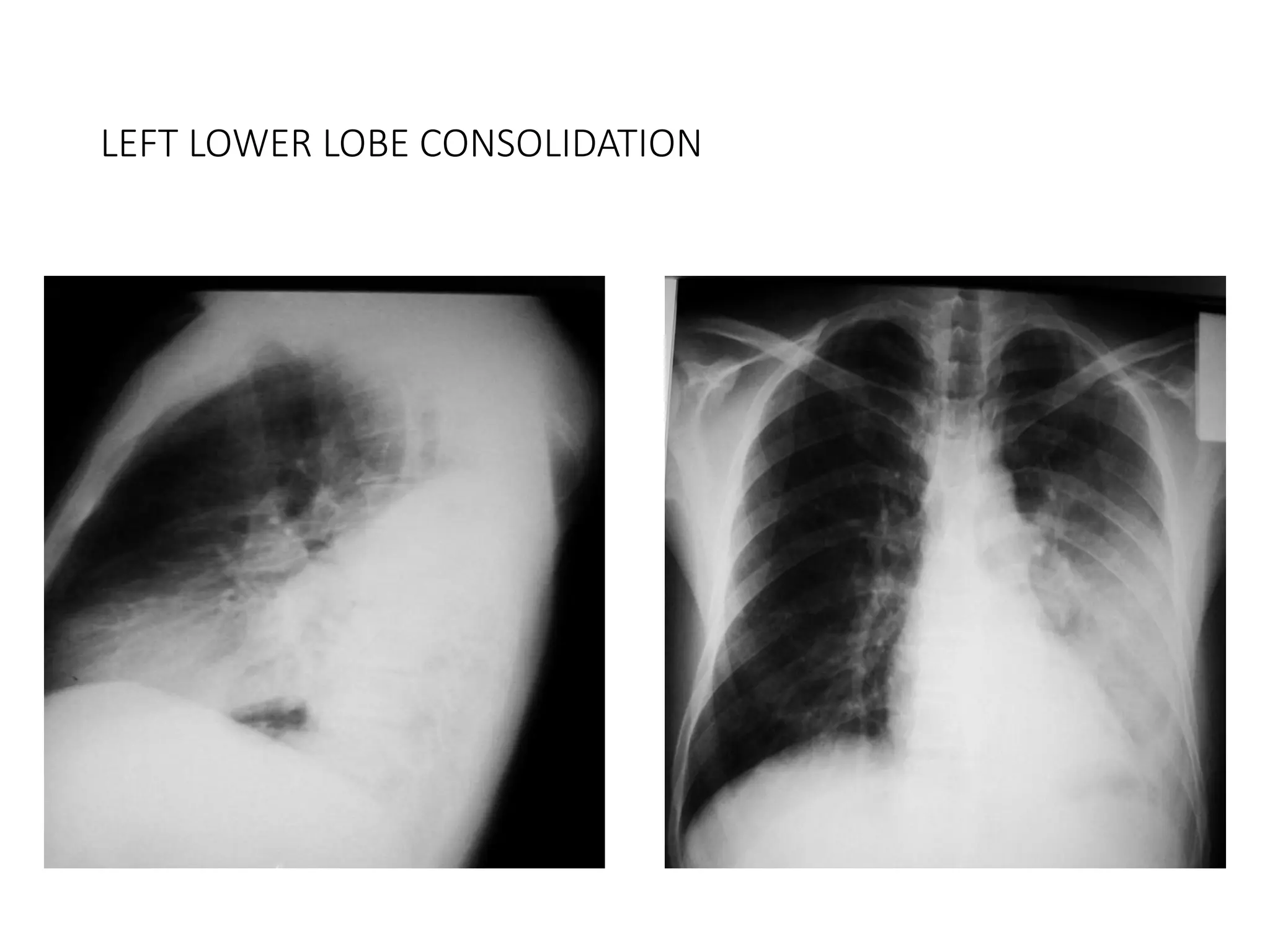 Collapse and Consolidation Pathology and radiology | PPTX