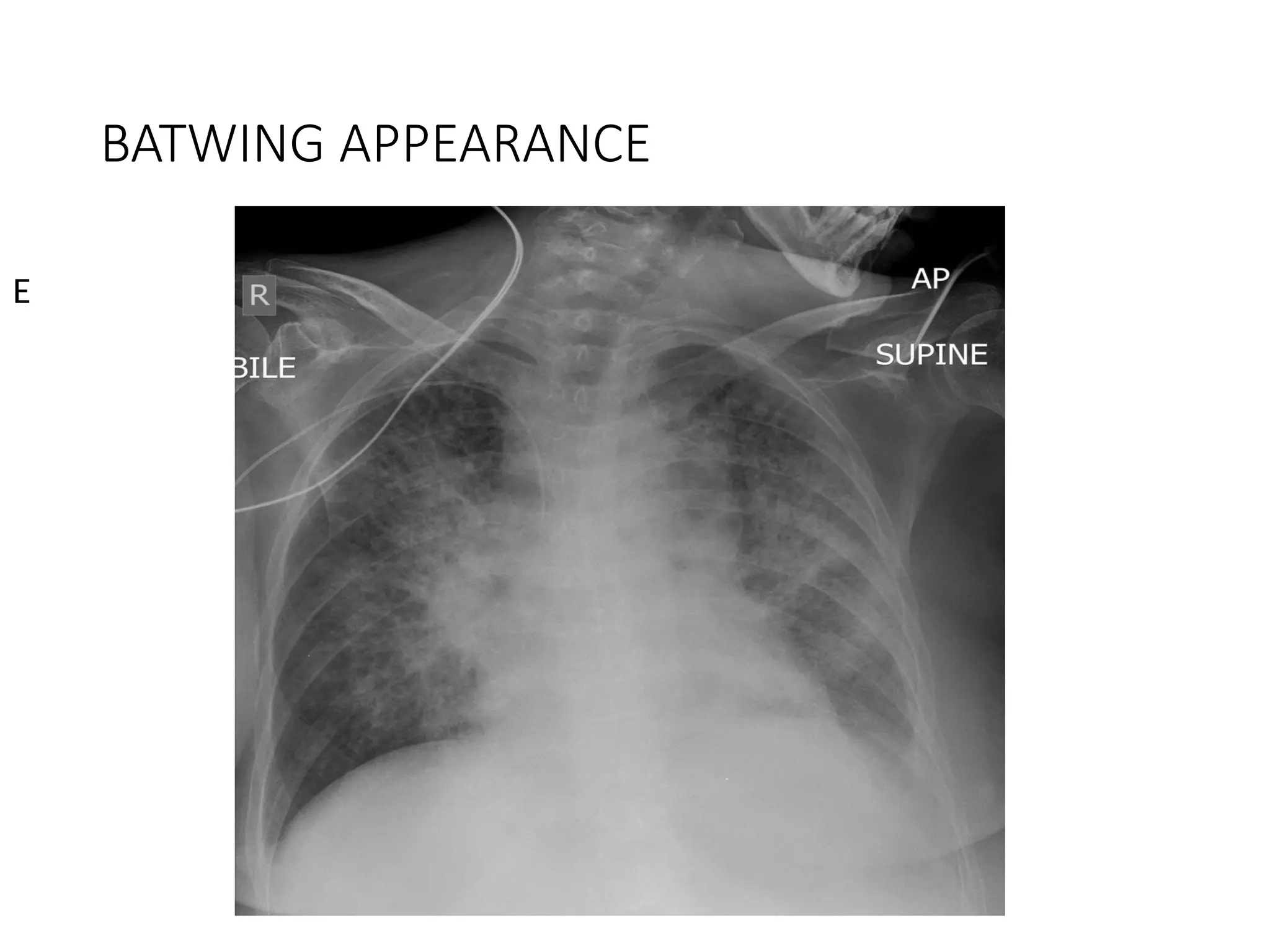 Collapse and Consolidation Pathology and radiology | PPTX