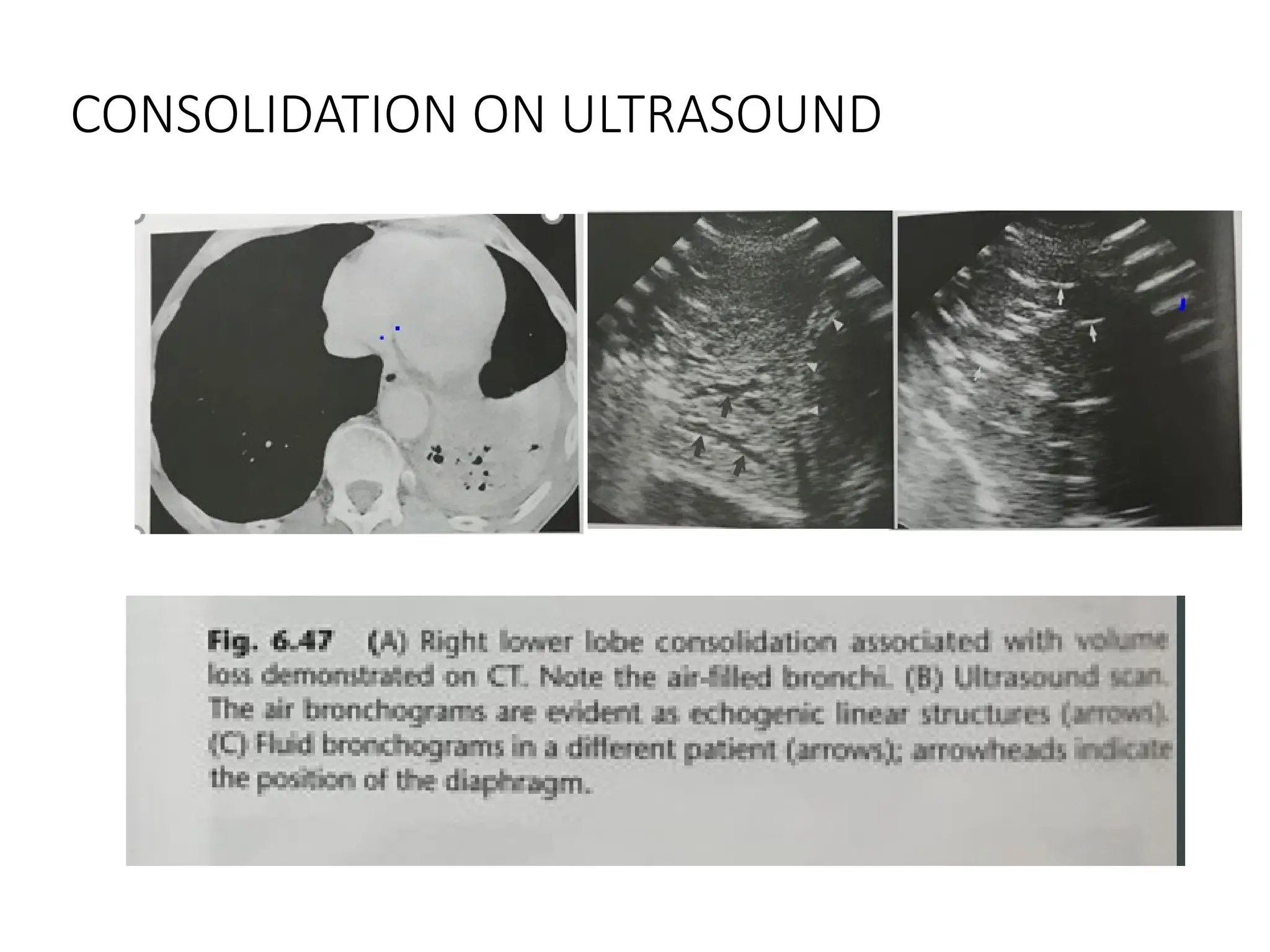 Collapse and Consolidation Pathology and radiology | PPTX