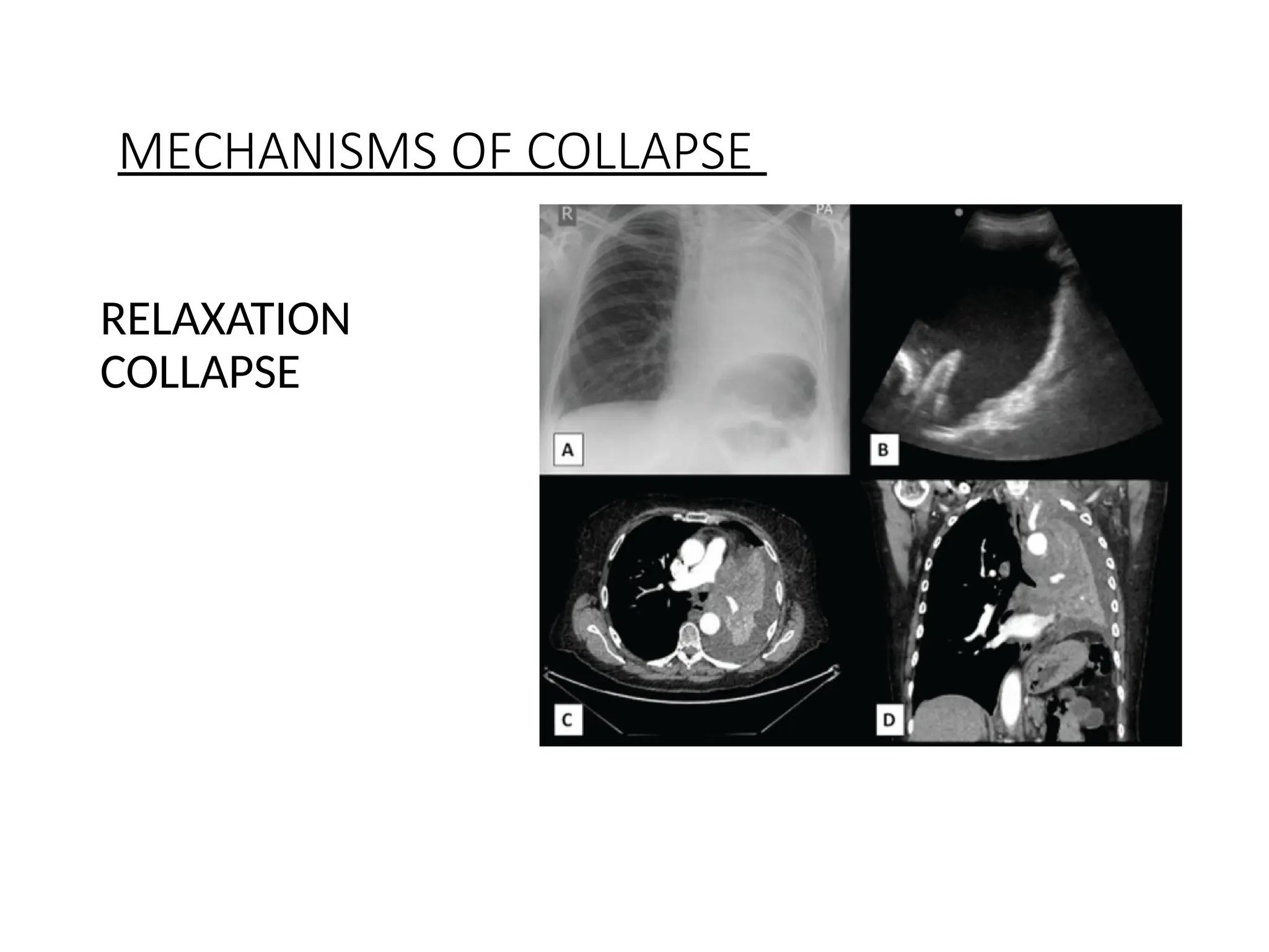 Collapse and Consolidation Pathology and radiology | PPTX