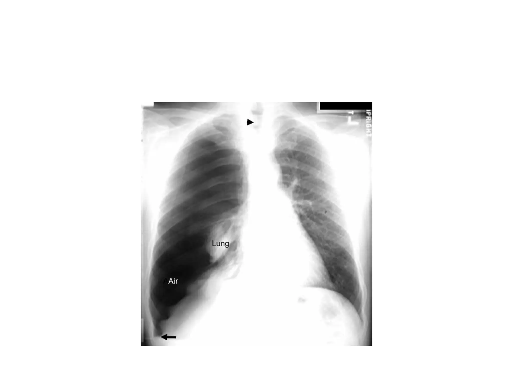 Collapse and Consolidation Pathology and radiology | PPTX