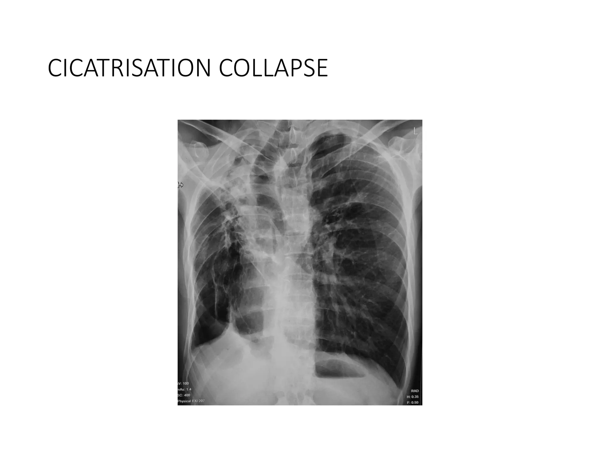Collapse and Consolidation Pathology and radiology | PPTX