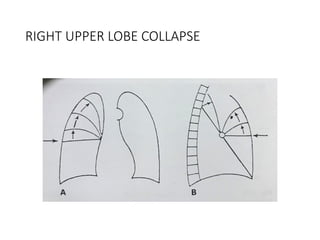Collapse and Consolidation Pathology and radiology | PPTX