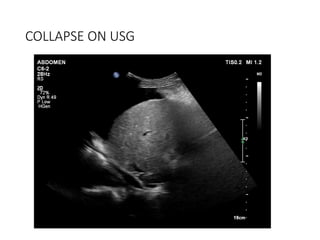 Collapse and Consolidation Pathology and radiology | PPTX