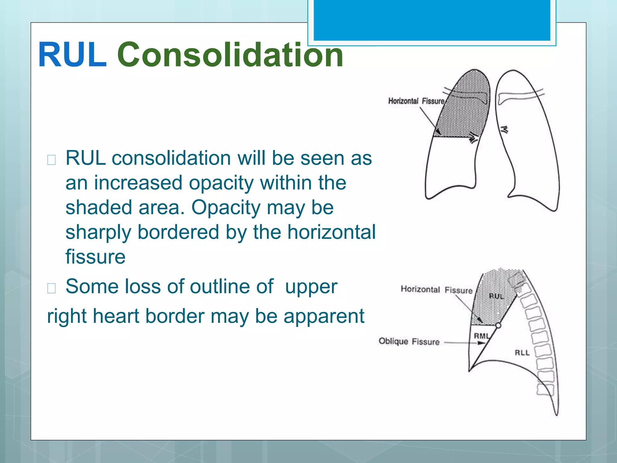 Collapse consolidation | PPTX