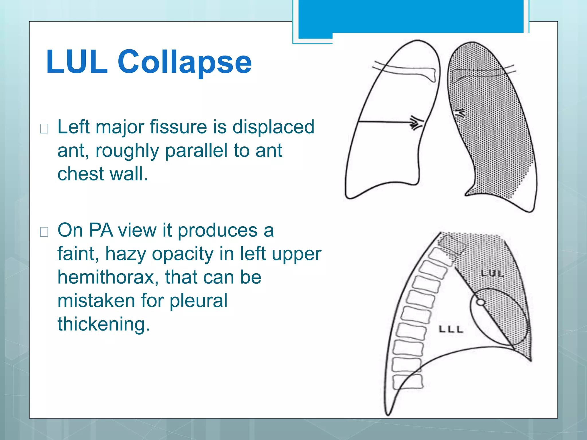 Collapse consolidation | PPTX