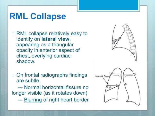 Collapse consolidation | PPTX