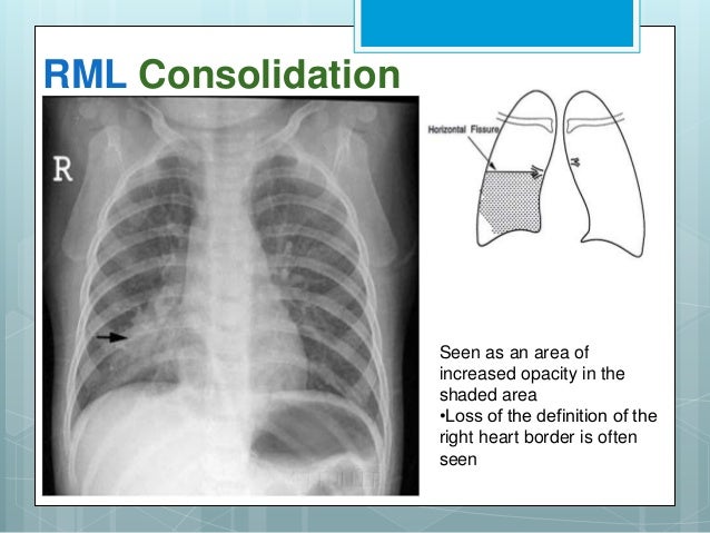 Collapse consolidation