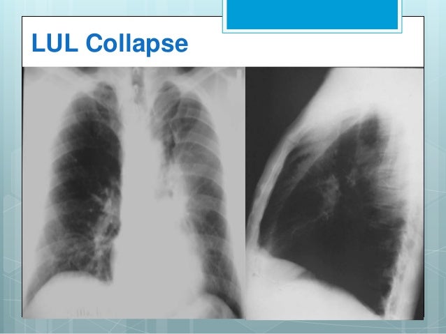 Collapse consolidation
