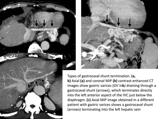 Collateral pathways in portal hypertension | PPTX