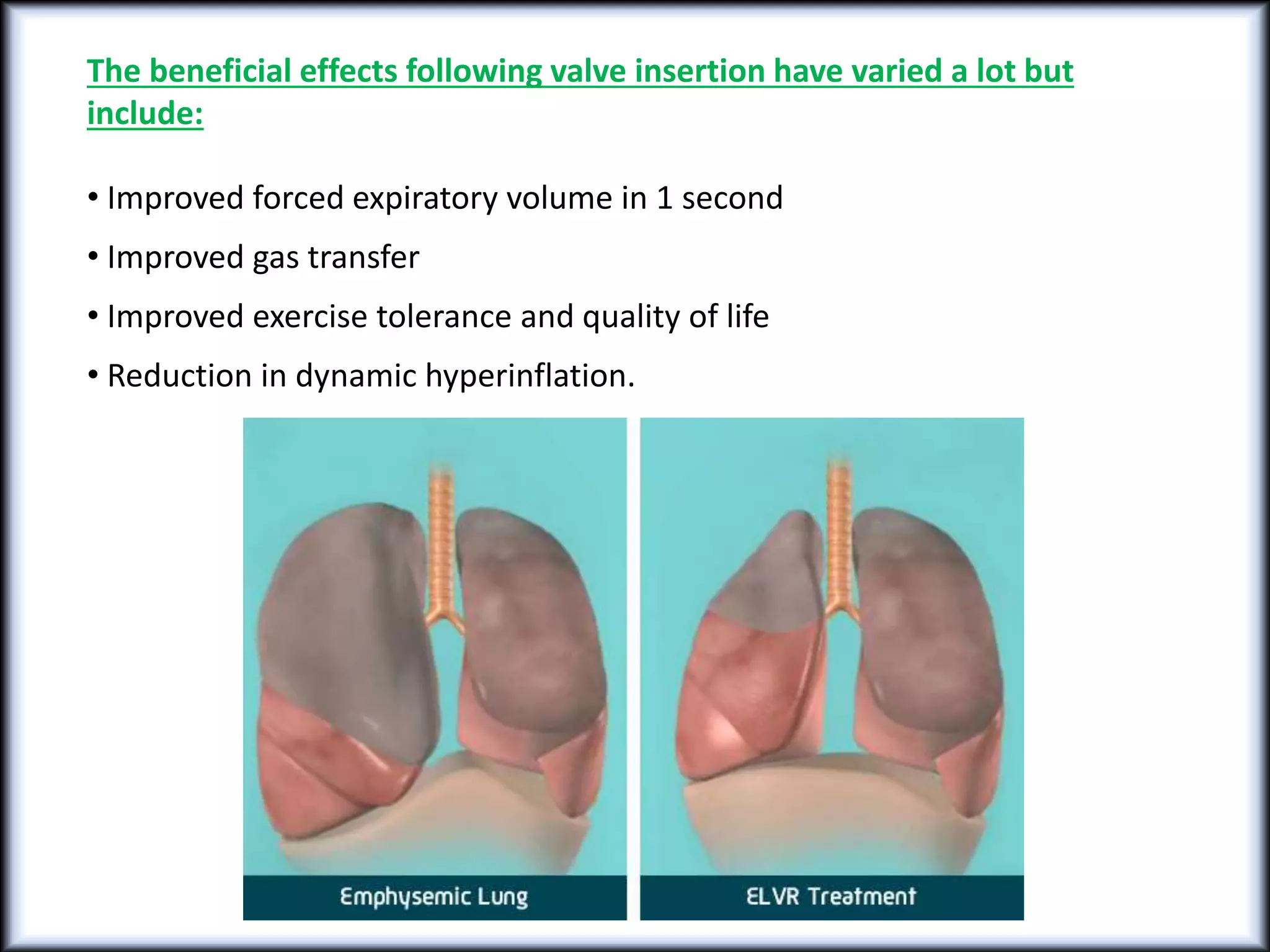 Collateral ventilation | PPTX