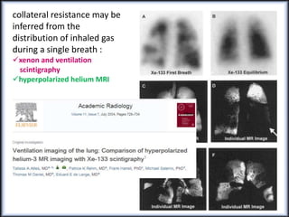 Collateral ventilation | PPTX