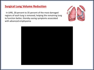 Collateral ventilation | PPTX