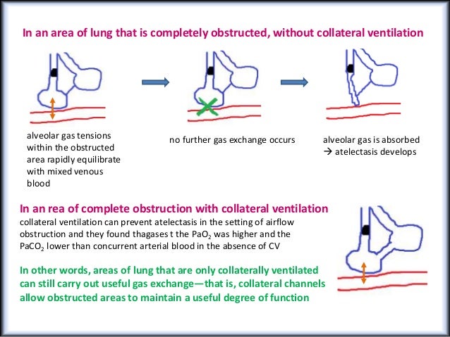 Collateral ventilation