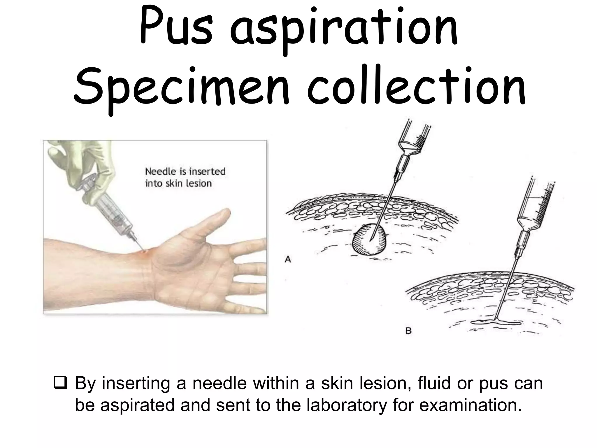 Collection and transport of ear discharges | PPTX