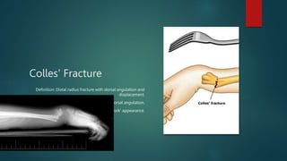 Colles' and Smith's fractures are common distal radius fractures with distinct characteristics ...