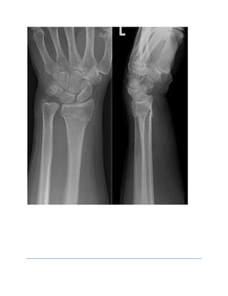 Colles fracture | DOCX