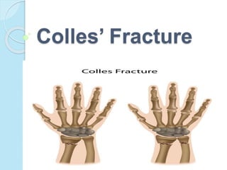 Colles' fracture | PPTX