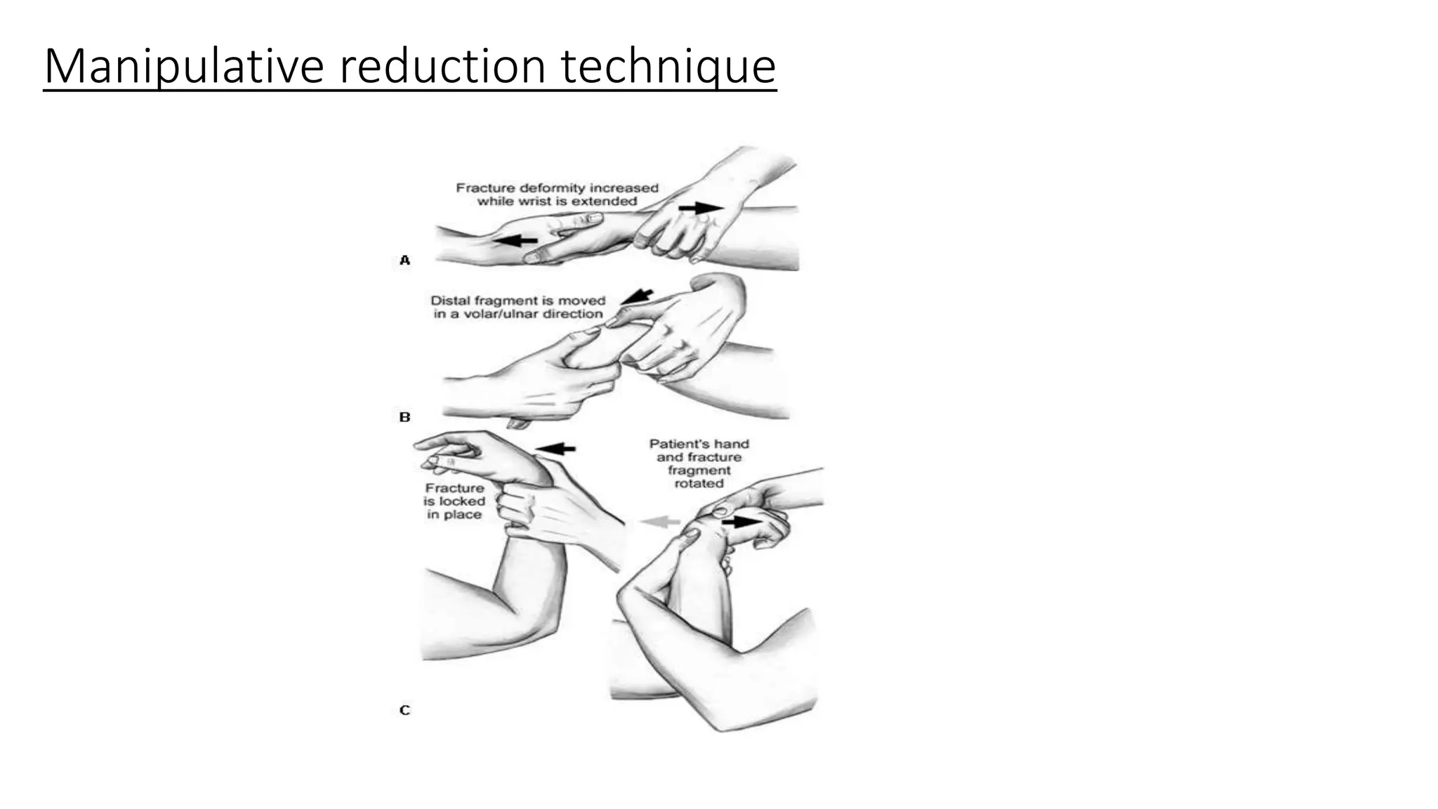 Colles fracture | PPTX