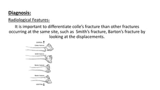 Colles fracture | PPTX
