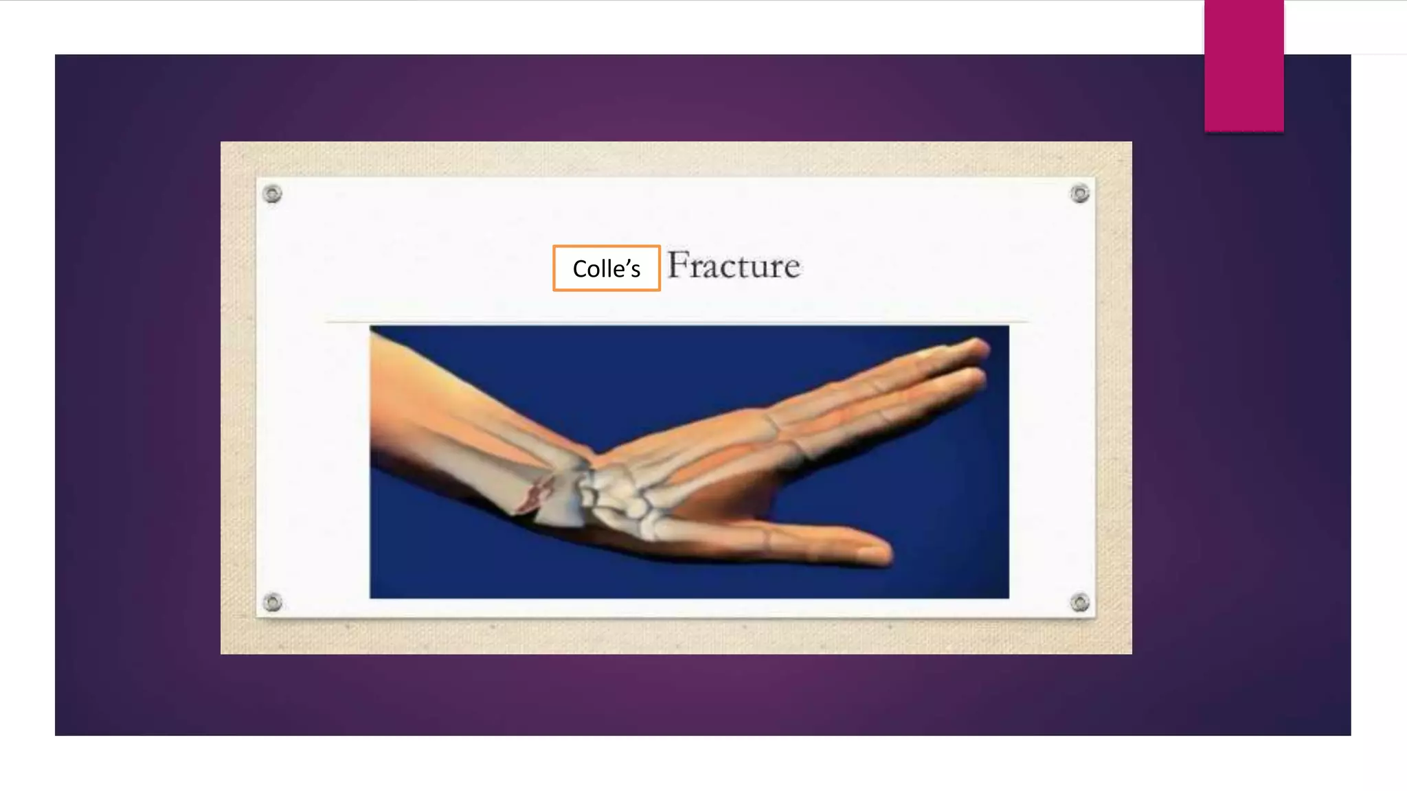 colle's fracture.pptx