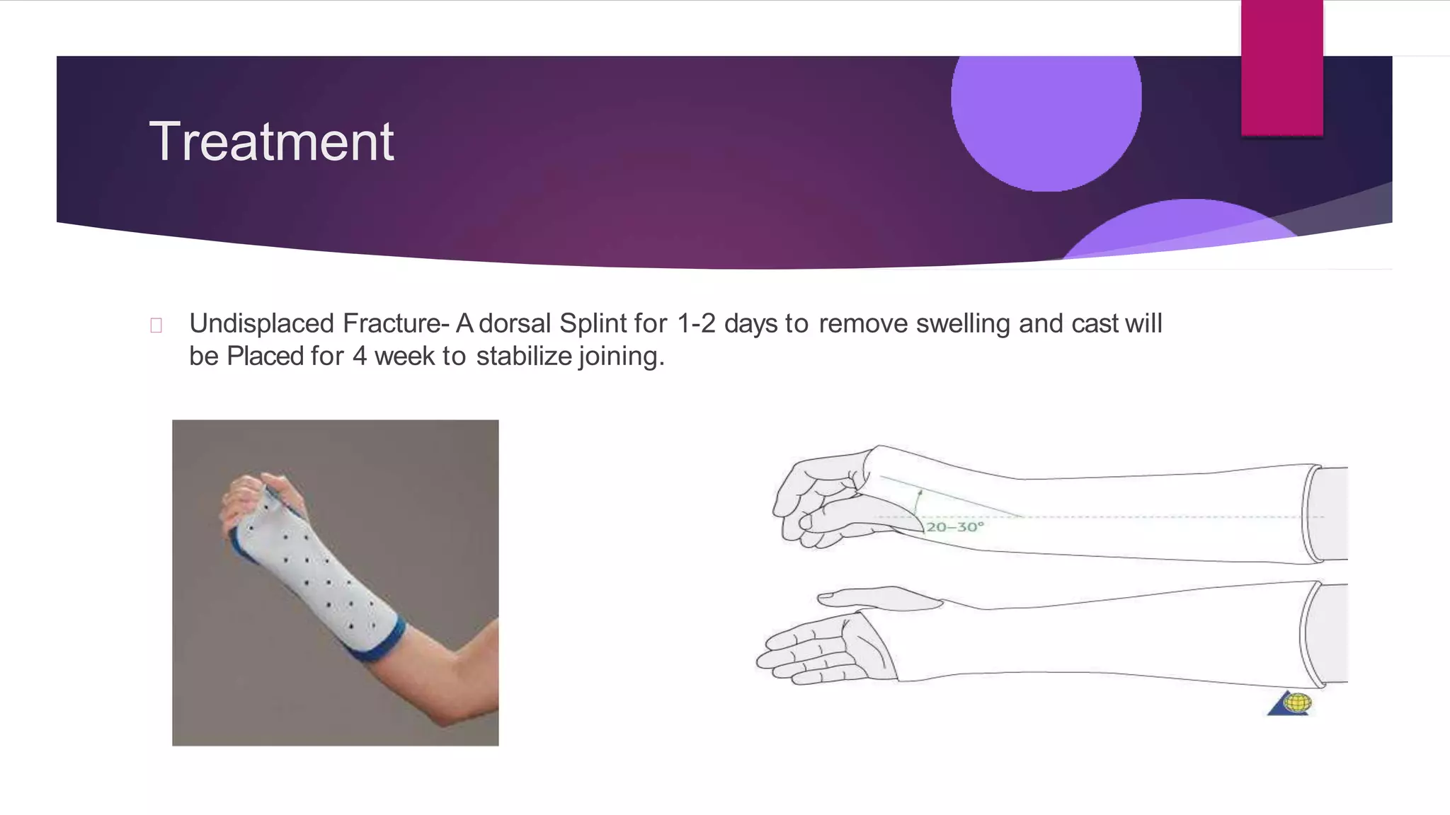 colle's fracture.pptx