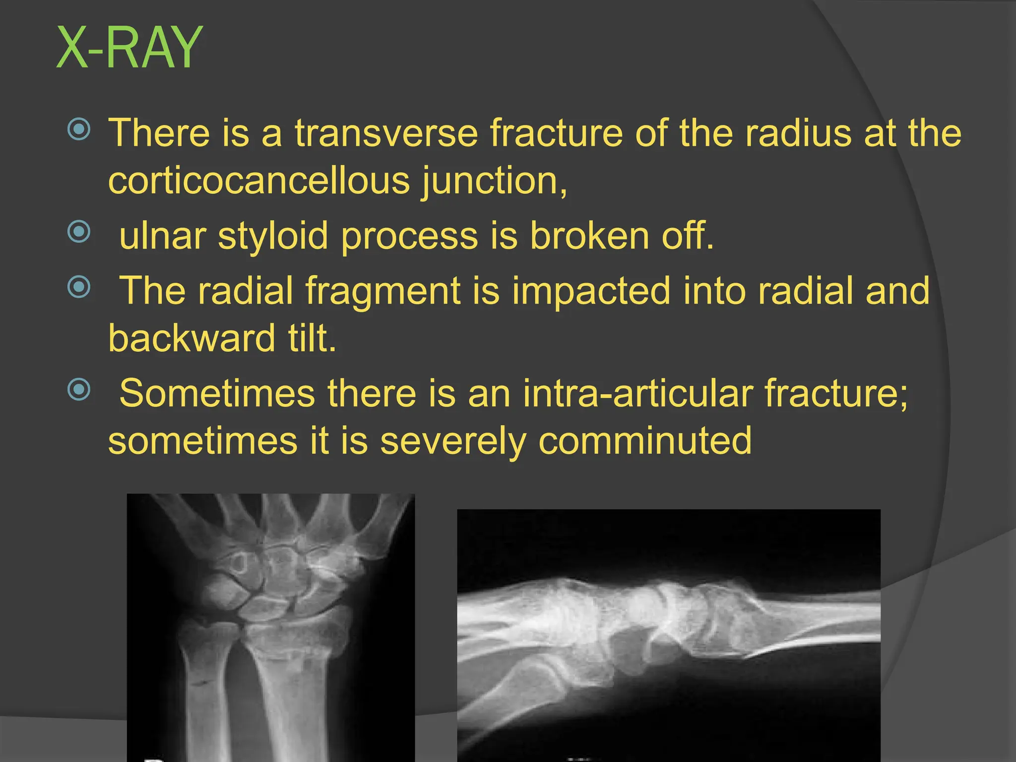 COLLES’ FRACTUREggggggggggggggggggggg.pptx