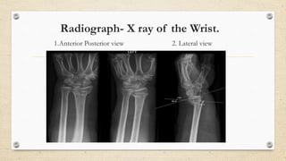 Colles fracture presentation | PPTX