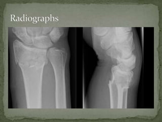 Colles’ fracture Power Point | PPTX