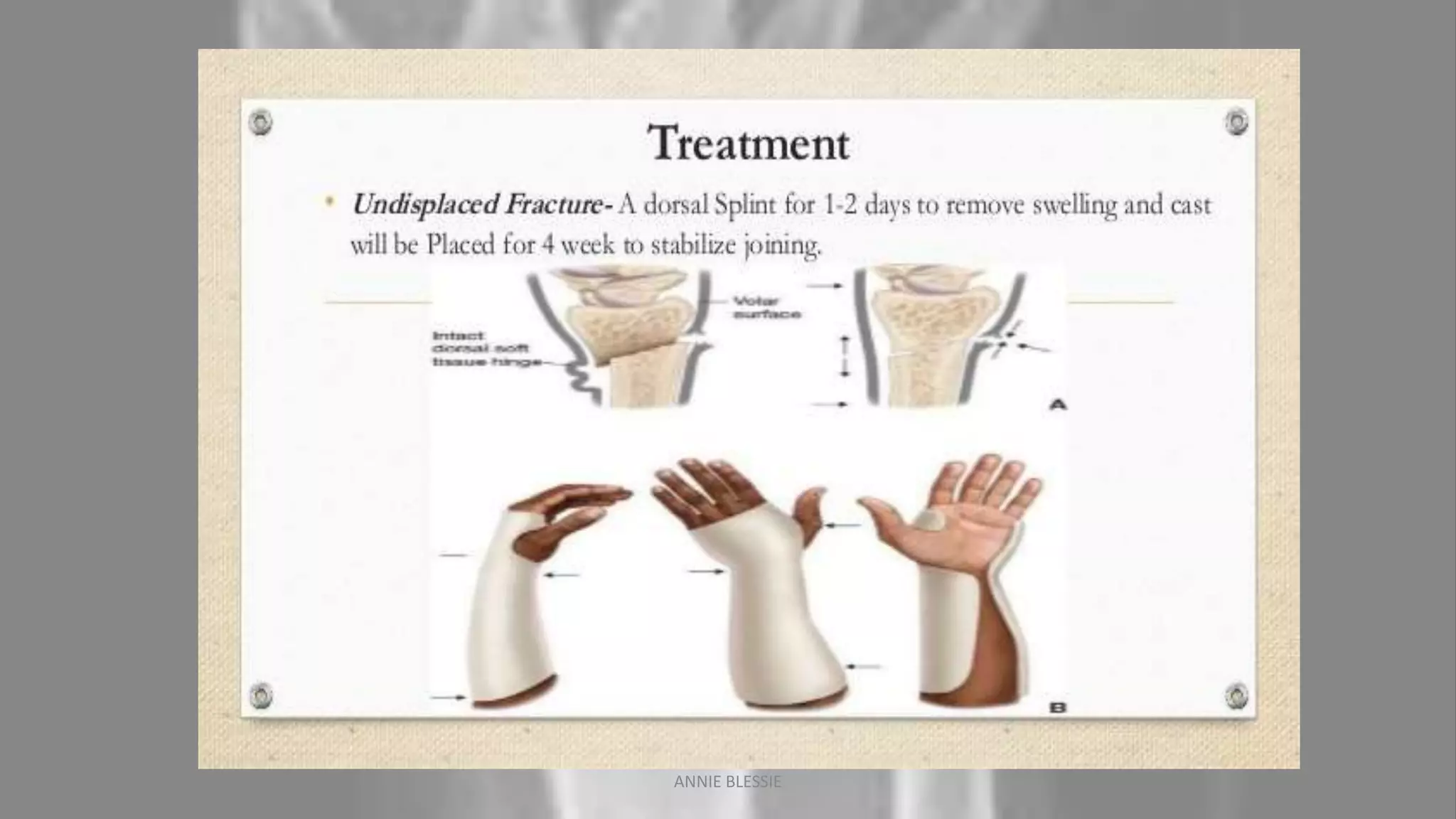 Colles' fracture & physiotherapy management | PPTX