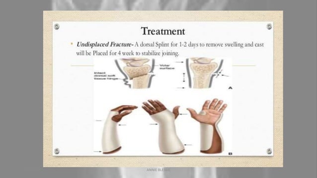 Colles' fracture & physiotherapy management | PPTX | Death, Injury, or ...