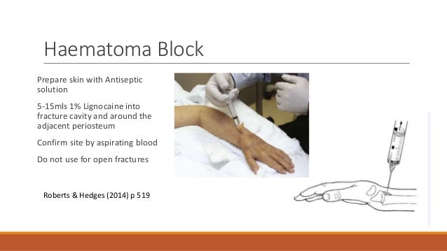 Colles' fracture reduction